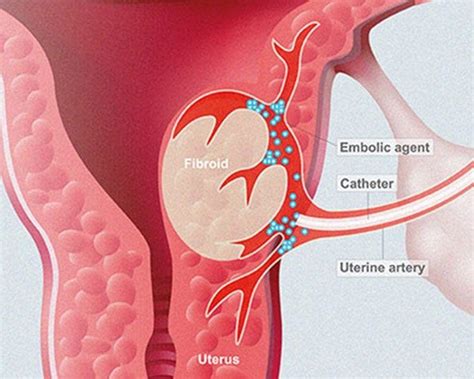 Uterine Artery Embolization In Borivali A Leap Towards Non Surgical