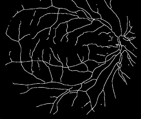 Figure 1 From Retinal Vessel Tree Segmentation Using A Deformable Contour Model Semantic Scholar