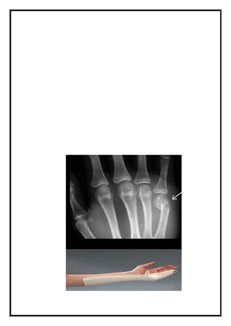 Metacarpal And Phalangeal Fractures Pdf D Khalid Muhadharaty