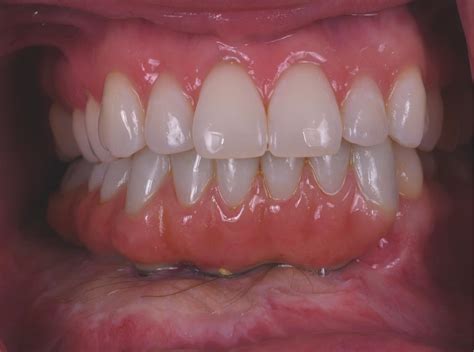 Evaluation Of Postoperative Peri Implant Reactive Tissues Following Implant Supported Prosthetic