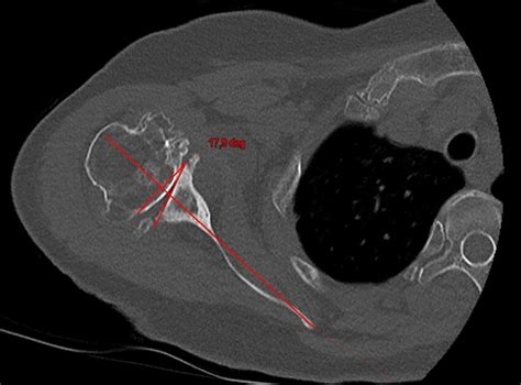 Preoperative Glenoid Retroversion Download Scientific Diagram