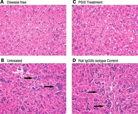 Ps2 Treatment Reduced Myeloma Tumor Burden In The Liver Hande Stained