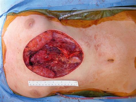 Lower Chest Reconstruction Clinical Tree