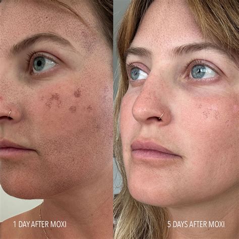 I Tried The Moxi Laser Treatment See Photos Ps Beauty