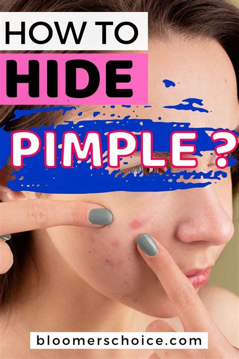How To Hide The Pimple Know How To Prevent Them Naturally