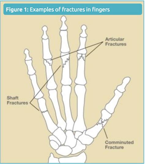 Metacarpal Crpp Broken Hand Lonestar Surgery Center