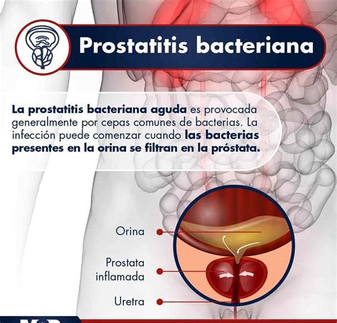 ¿qué Es La Prostatitis Y Cómo Se Trata Doctor Benjamin Díaz Curiel