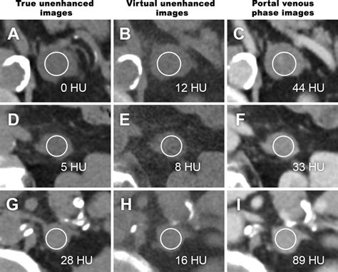 Radiology On Twitter Photon Counting Detectors In Virtual Unenhanced Ct Does This Technology