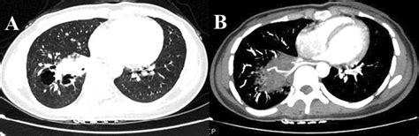The Sequestrated Lung Located In The Right Lower Lobe Was Diagnosed