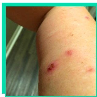 Dermatillomania Aka Skin Picking Disorder Excoriation Excoriation