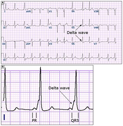Delta Wave Ecg