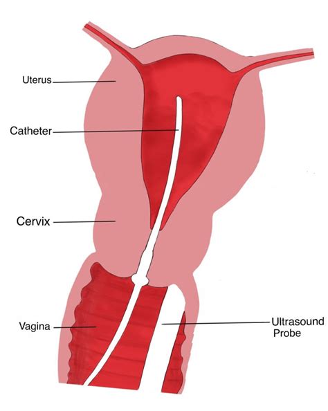 Utility Of Saline Infusion Sonohysterography In Gynecology A Review