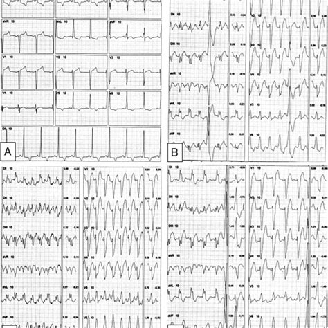 New Onset Of Intermittent Left Bundle Branch Block During A Download Scientific Diagram