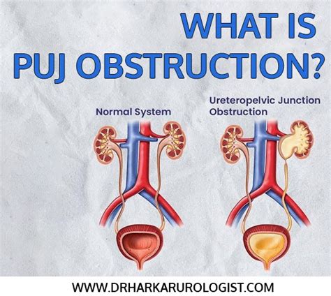 What Is Pelvic Ureteric Junction Puj Obstruction Best Urologist In
