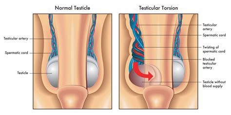 Understanding Testicular Torsion Causes Symptoms And Treatment