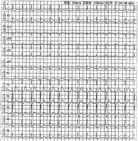 Ecg After Resolution Of Hyperkalemia The Peaked T Wave And Upsloping Download Scientific