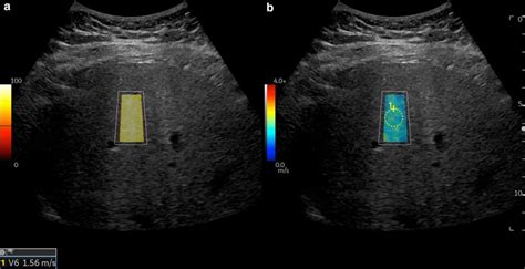 Shear Wave Elastography Swe With Confidence Map Some Vendors Provide Download Scientific