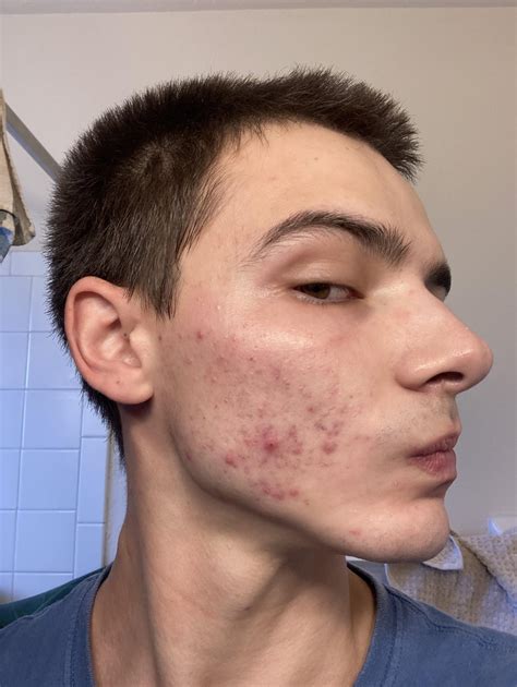 2 5 Month Progress 0 05 Tret Doxycycline R Tretinoin