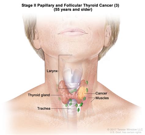 Paratracheal Nodes