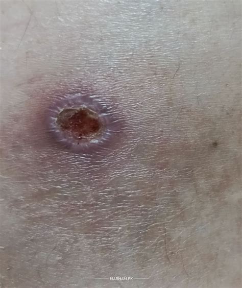 Ask A Dermatologist Online For Is This A Boil With Abscess Or Else