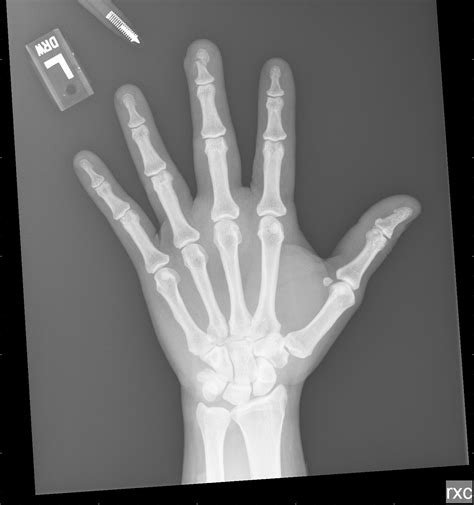 Tuft Fractures Part I Closing The Gap