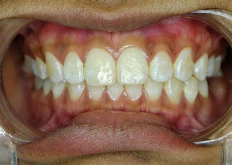 What Is The Small Black Point On My Tooth