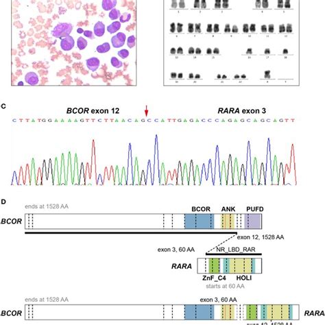Morphology Cytogenetic And Molecular Analysis Of A Bone Marrow Sample Download Scientific