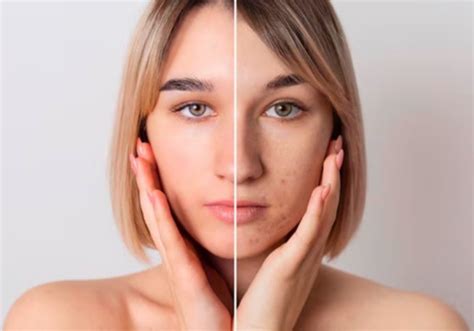 Pie Vs Pih Ini Beda Jenis Bekas Jerawat