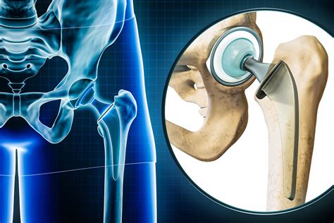 A Comprehensive Guide To Total Hip Replacement Surgery