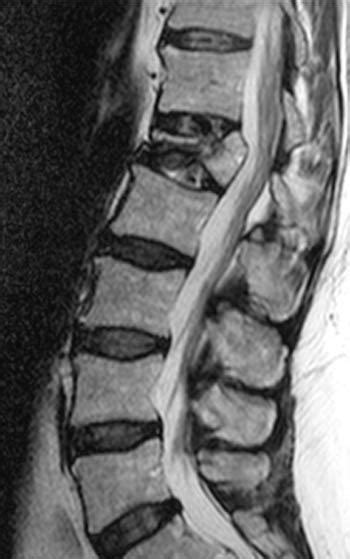 Pathologic Fractures Radsource