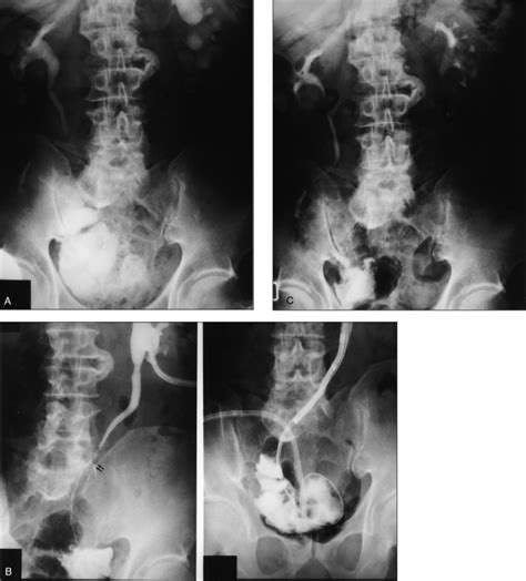 Patient 3 A 57 Year Old Man With Indiana Urinary Pouch A Excretory