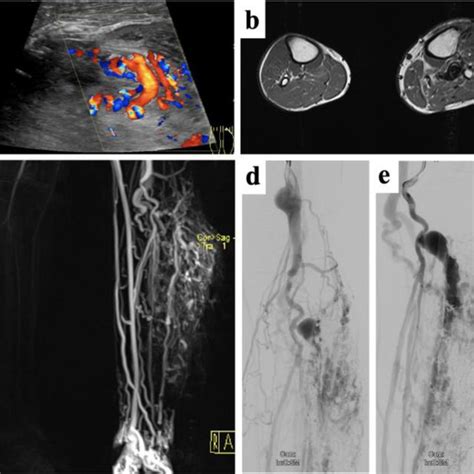 Infrared Thermography Of An Arteriovenous Malformation Of The Face A