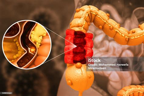 Colon Cancer Colon Polyp Removal Endoscope Inside Colonoscopy For Colon Polyps Search 3d