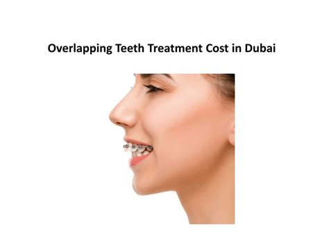 Ppt Overlapping Teeth Treatment Cost In Dubai Powerpoint Presentation