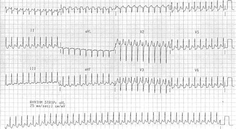 The St Segment • Litfl • Ecg Library Basics