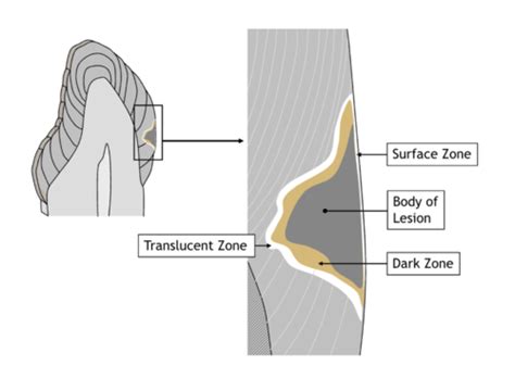 Enamel Caries Flashcards Quizlet