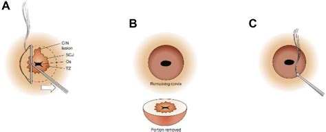 Management Of Cervical Dysplasia Using Office Loop Electrosurgical Excision Procedure Primary