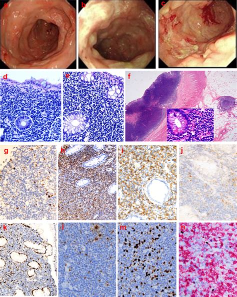 Endoscopy Shows Ulcer At Fred Morales Blog