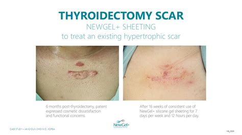 Thyroid Surgery Recovery Scar Care And Healing Tips Newgel