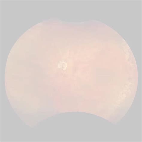 Optos On Linkedin Optos Optomap Retina Myopia