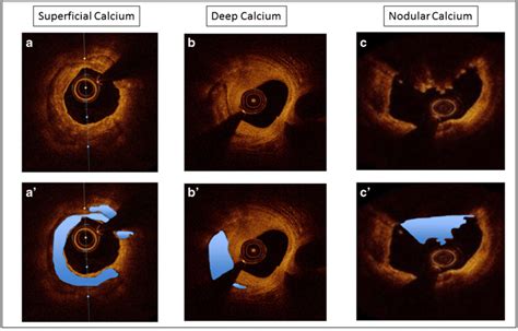 Classification Of Calcification Oct Cross Section Demonstrating Download Scientific Diagram