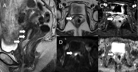 Magnetic Resonance Imaging Of The Polypoid Mass A Sagittal And B Download Scientific Diagram