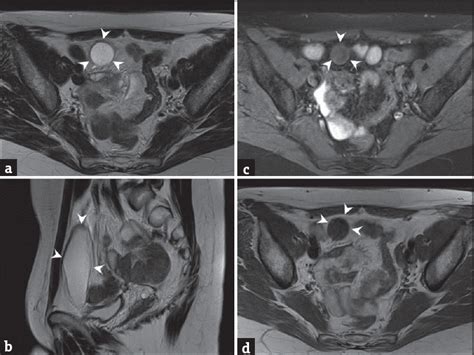 Mucinous Neoplasm Of The Appendix As A Mimic Of Cystic Adnexal Pathology Journal Of Clinical