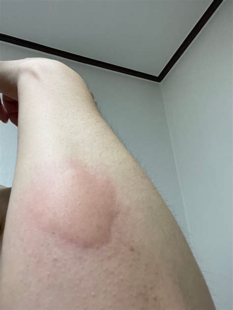 벌레물린자국 지식in