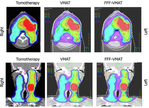 Treatment Plans For Helical Tomotherapy Ht Volumetric Arc Therapy Download Scientific