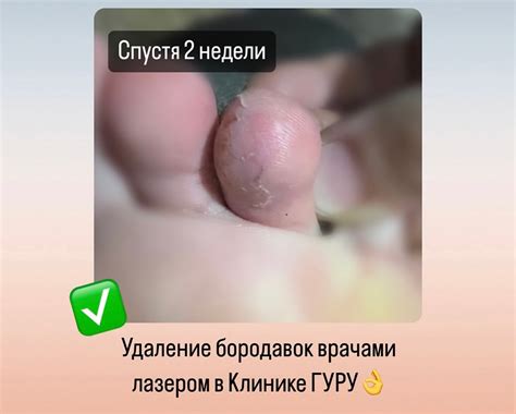 Удаление бородавок в Минске Цены Отзывы Онлайн Запись Клиника ГУРУ