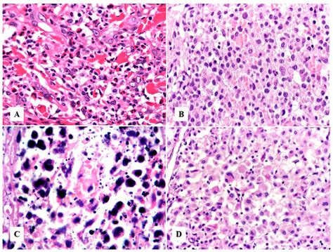 Histologic Variants Of Primary Cutaneous Anaplastic Large Cell