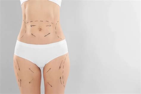 Post Liposuction Scarring What To Expect Top Surgeons Mexico