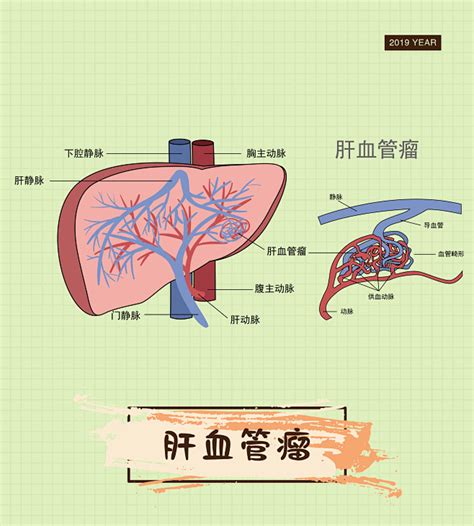 肝血管瘤 人体消化系统肿瘤癌症细胞疾病症状医疗人体系统 人体解剖 人体器官内脏 医疗图 人体结构 人体医学研究 人体部位 医疗保健医疗护理 医疗疾病插画 卡通手绘漫画