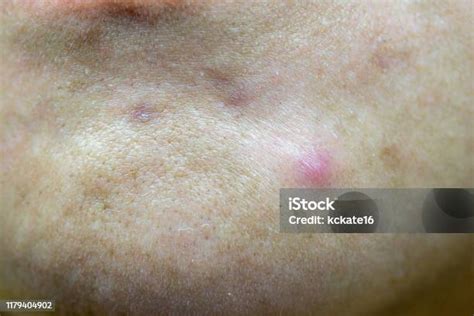 결절 낭포 성 여드름 피부의 사진 여성 표면에 만성 여드름 피부 여드름 문제가있는 여성 여드름에 대한 스톡 사진 및 기타 이미지 Istock